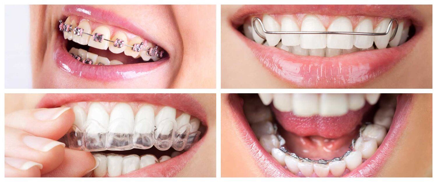 braces evolution